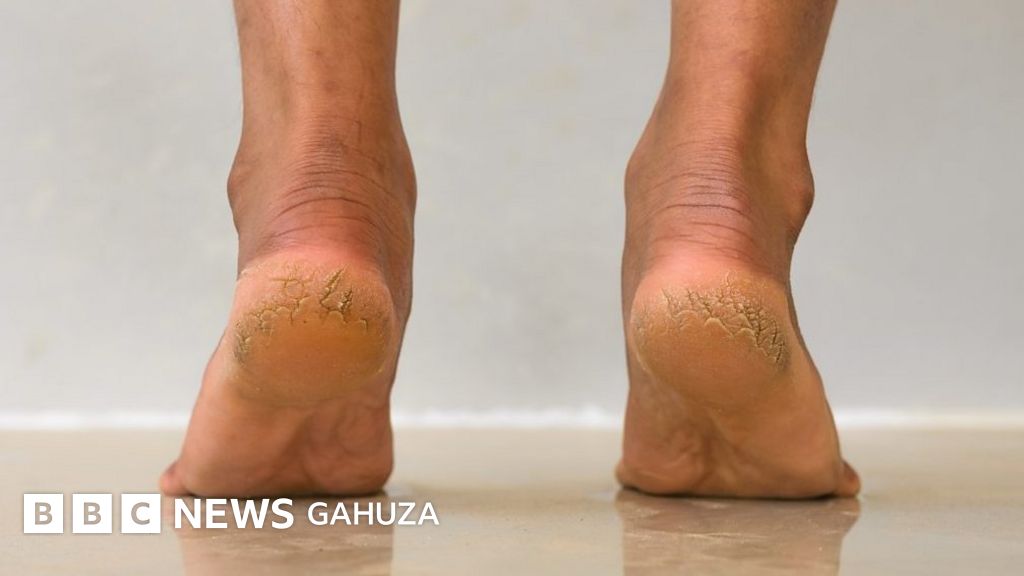 Bazamuganga: Umva ibisobanuro bya Muganga ku ndwara y'ibigatu cyangwa ...