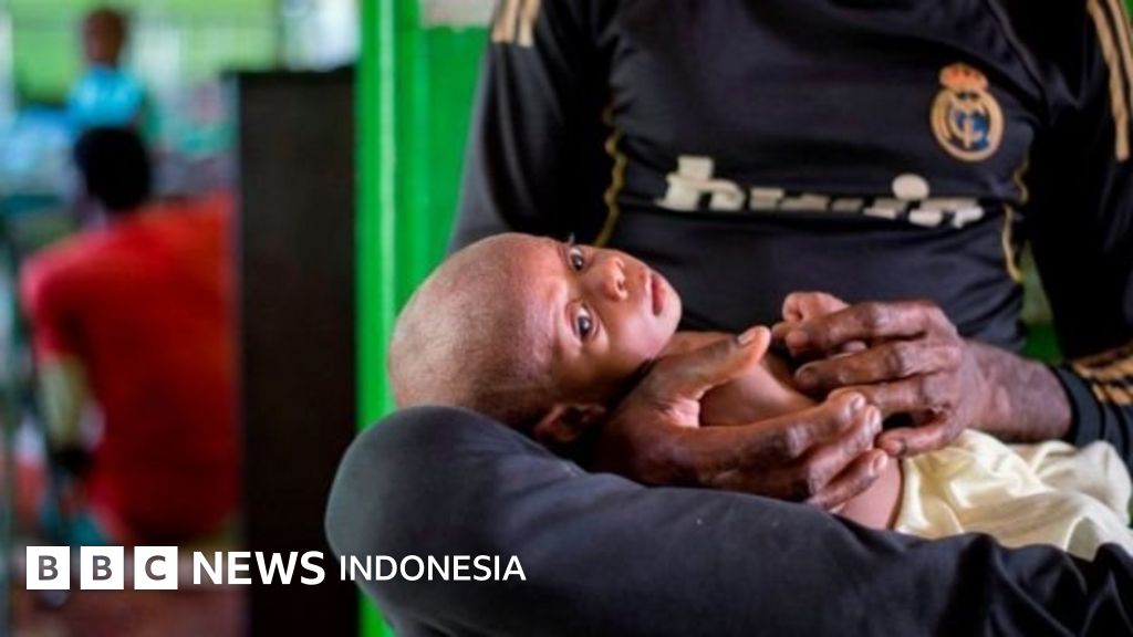 Kematian anak akibat gizi buruk di Asmat berlanjut meski KLB sudah berakhir - BBC News Indonesia