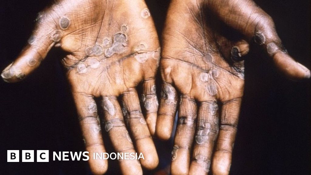 Cacar monyet ditemukan di Singapura, seberapa berbahaya penyakit ...