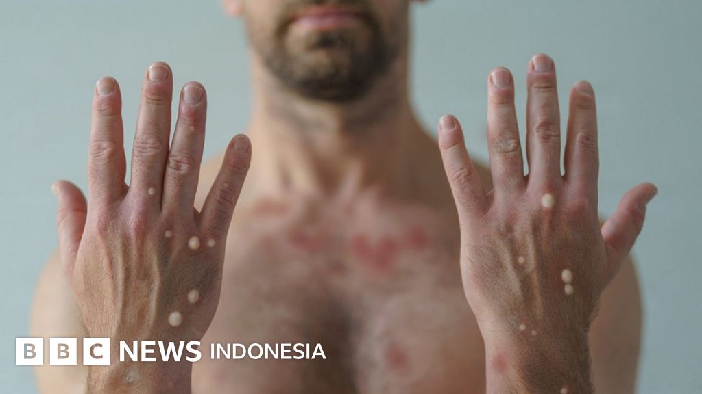 Cacar monyet: Pasien terkonfirmasi pertama di Indonesia ditemukan di ...