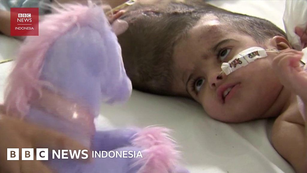 Operasi pemisahan anak kembar siam dempet kepala asal Pakistan berhasil dilakukan - BBC News ...