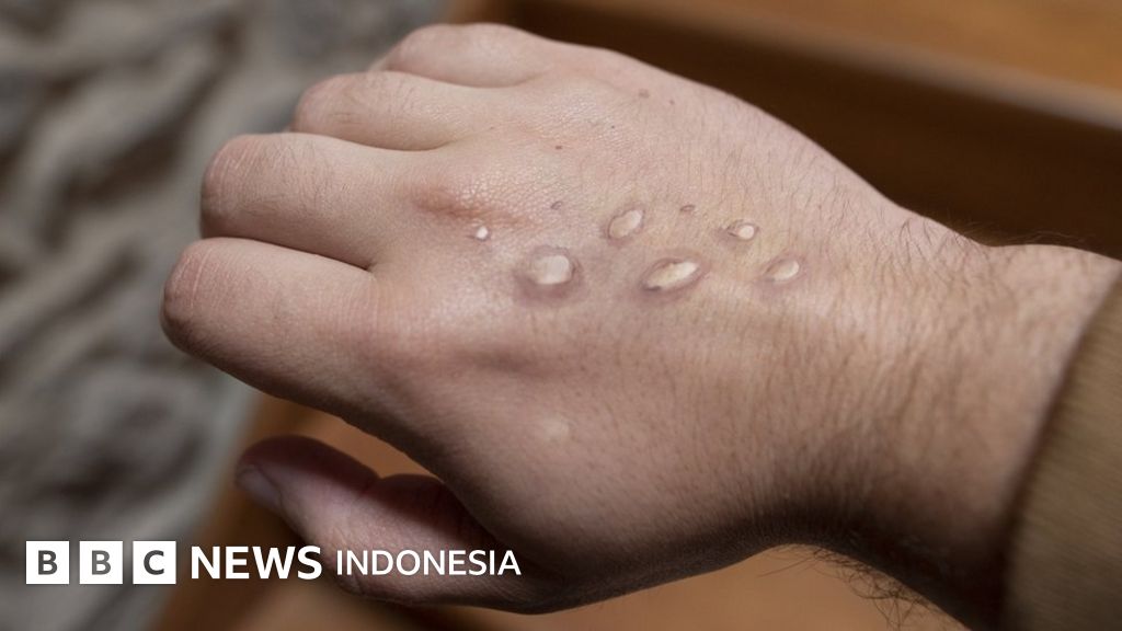 Cacar Monyet: Kesaksian pria yang kulit kelaminnya melepuh - 'Rasanya ...