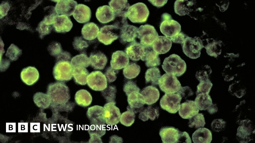 Infeksi otak langka yang diakibatkan amoeba 'pemakan otak' ditemukan di ...