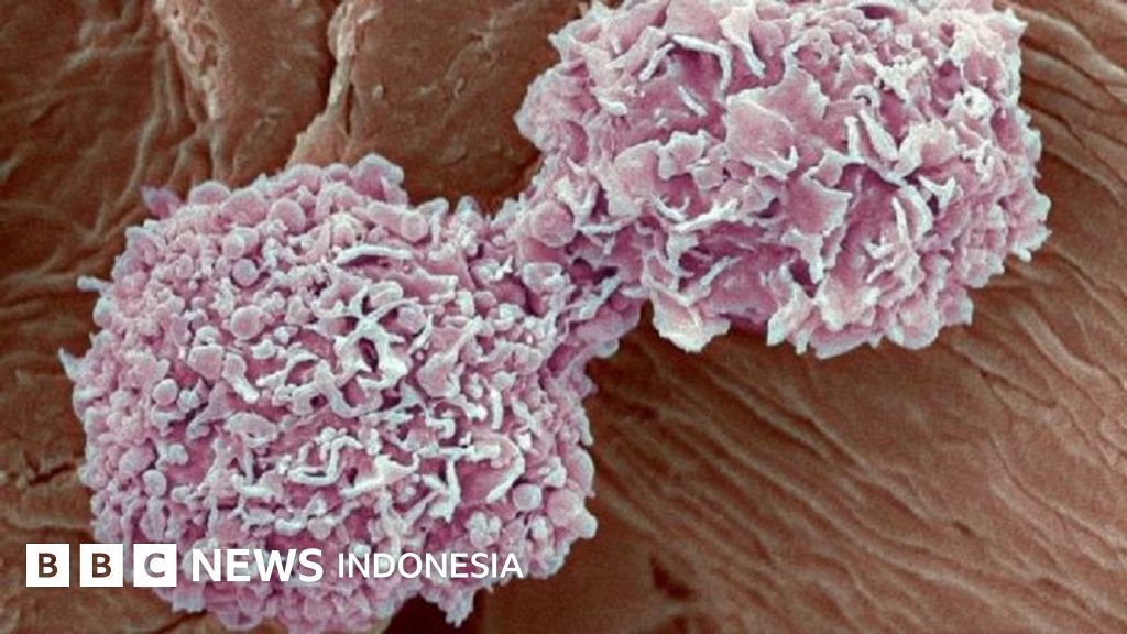 Meluruskan berbagai mitos tentang kanker yang beredar di internet - BBC ...