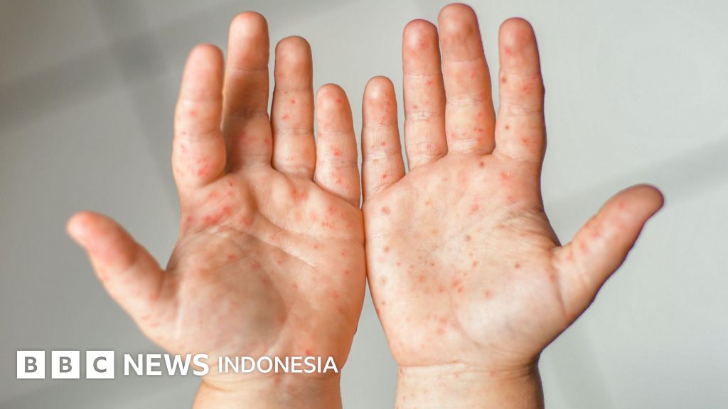 Flu Singapura berpotensi meluas saat mudik Lebaran - Bagaimana ciri ...