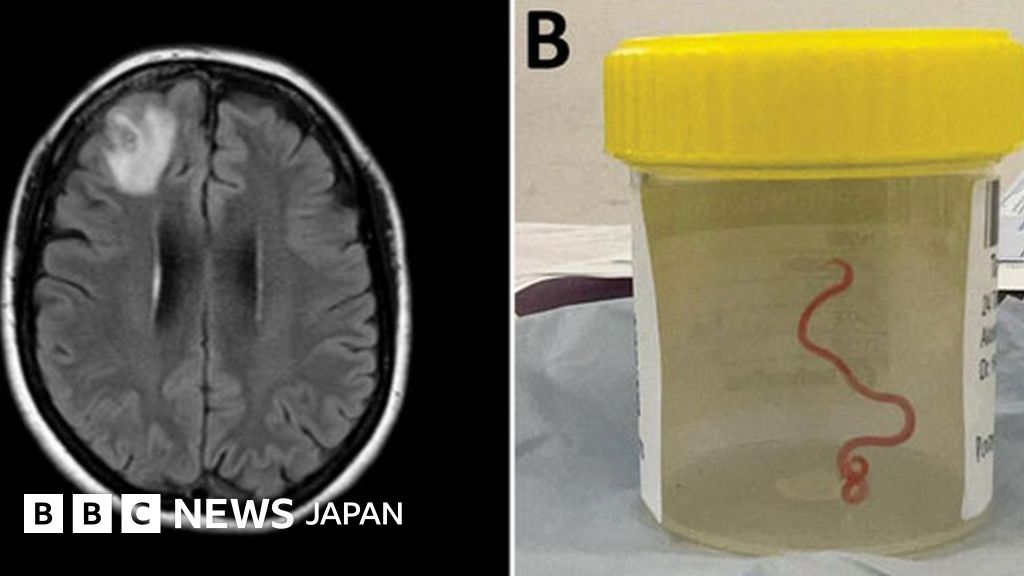 人間の脳で生きた線虫が見つかる、世界初の症例 オーストラリア - BBCニュース