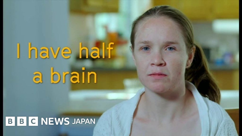 「普通の人と変わりない」 脳半分を摘出した女性 Bbcニュース