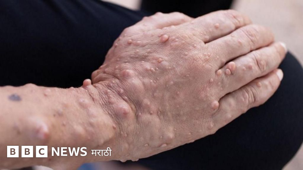 Neurofibromatosis : संपूर्ण शरीरावर फोड आणणारा आजार, ही आहेत लक्षणं आणि ...
