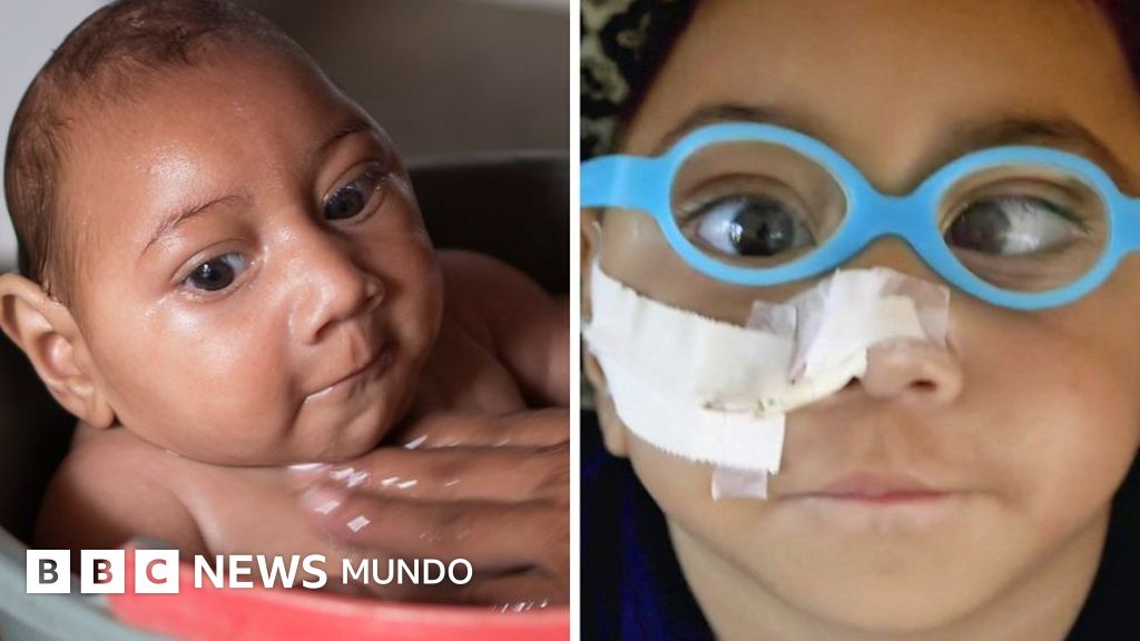 Cómo está un año después José Wesley, el bebé símbolo del zika en ...