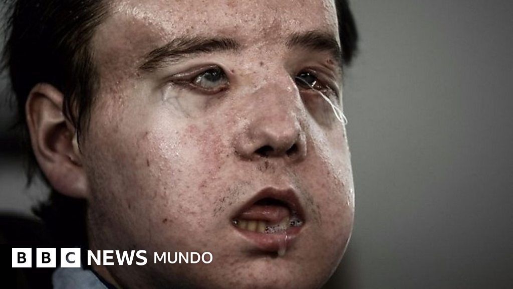El primer paciente que recibe dos trasplantes de cara en el mundo - BBC ...