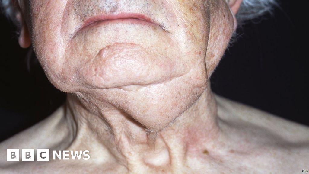 Head and neck cancer drug 'game changer' - BBC News