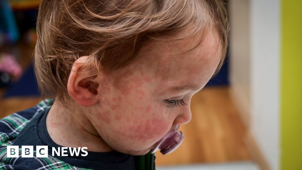 Measles: Cases in Northern Ireland 'only a matter of time'
