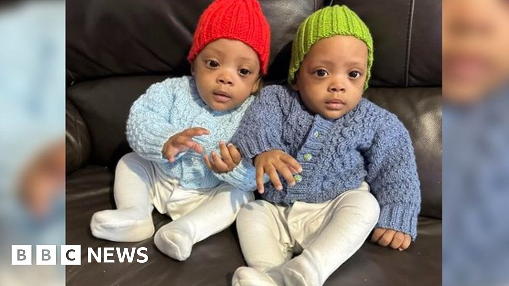 Middlesbrough conjoined twins celebrate first birthday - BBC News