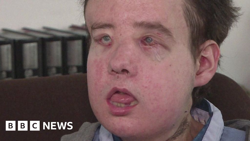 First double face transplant patient 'well' in France - BBC News