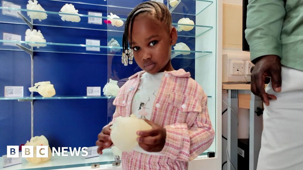 3D heart models revolutionise ops, Southampton surgeon says