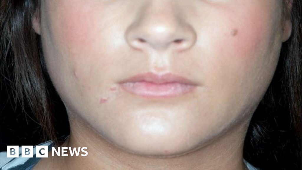 Mumps Is It The Forgotten Disease 