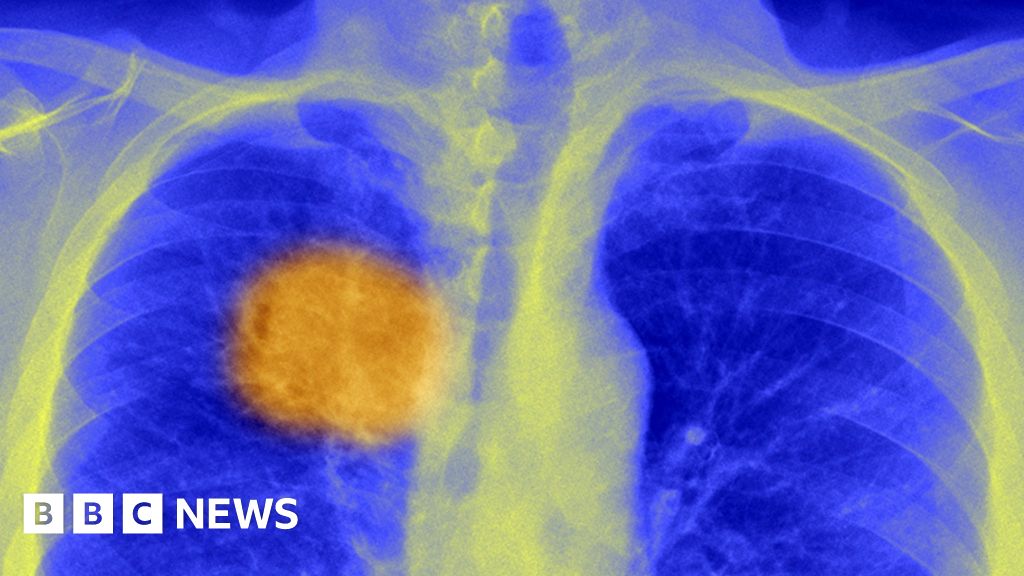 Scientists 'find cancer's Achilles heel' - BBC News