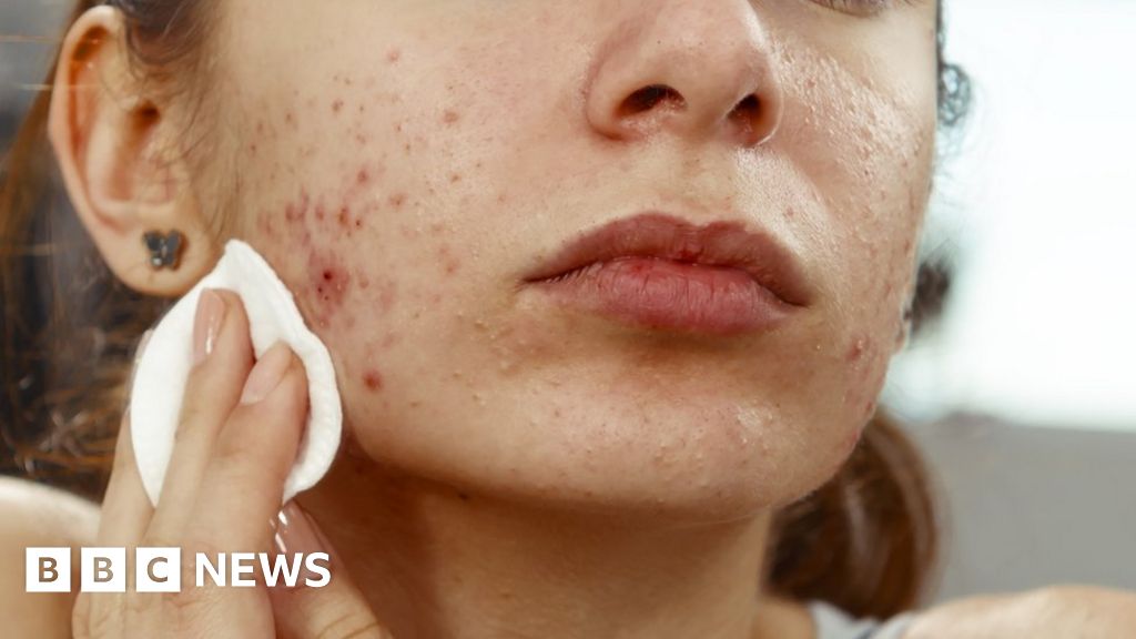 Can high street acne treatments really get rid of your spots? - BBC News
