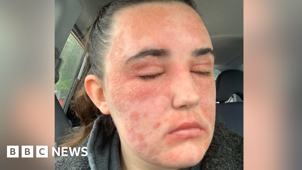 Eczema flare-ups sealed 22-year-old's eyes and mouth shut - BBC News
