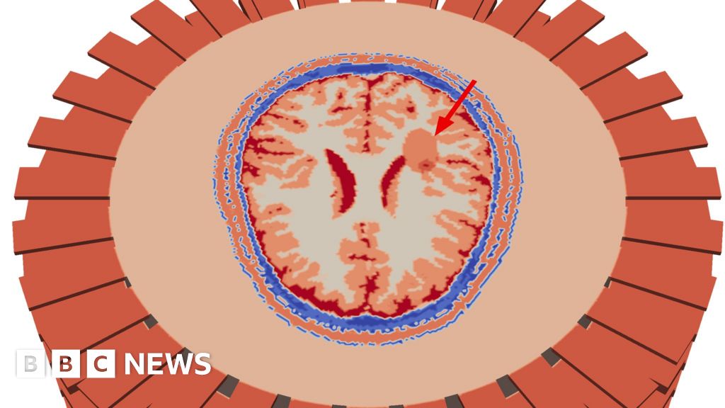 Scots university aids work to develop speedier stroke diagnosis - BBC News