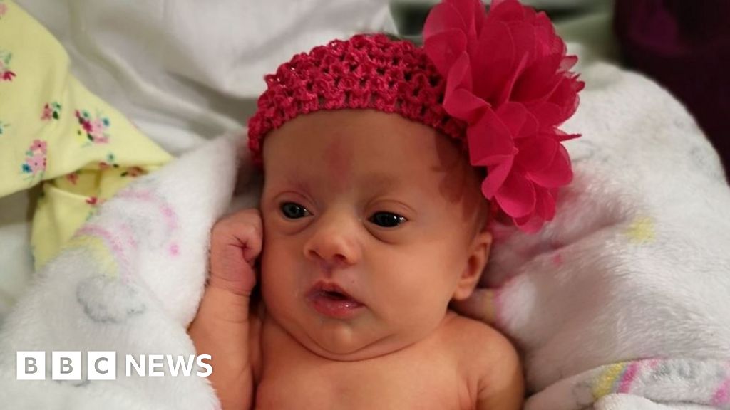 Spina bifida womb op baby back home in Essex - BBC News