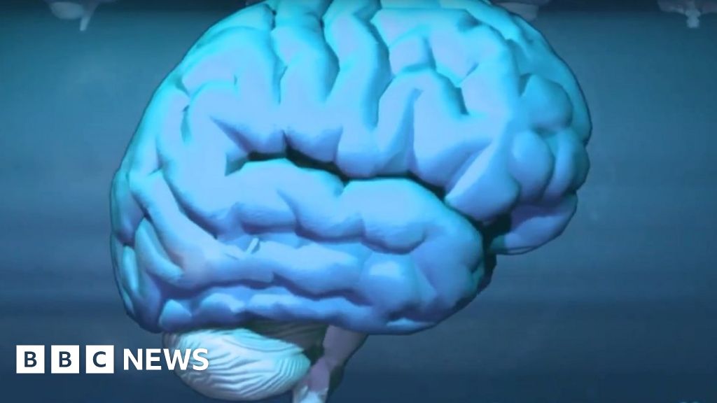 Aberdeen and Mysore brain scans in Alzheimer's study