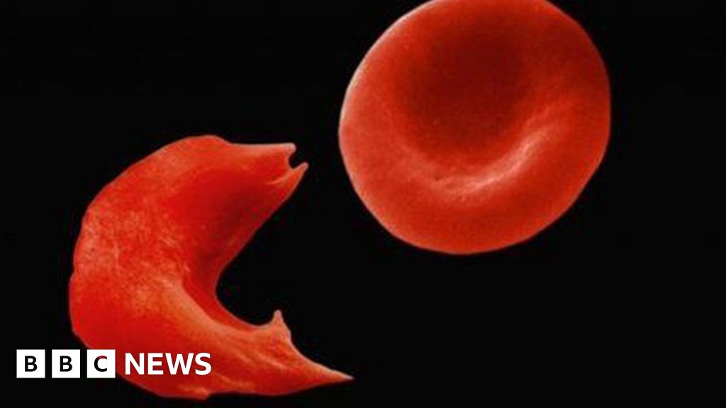 Sickle cell gene therapy: 'It gives me joy and hope' - BBC News