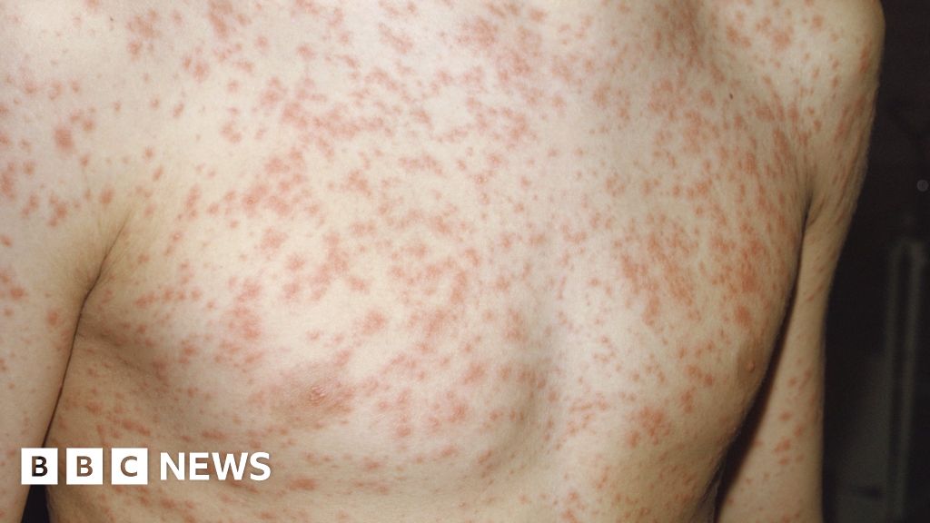 Rubella screening to end in England - BBC News