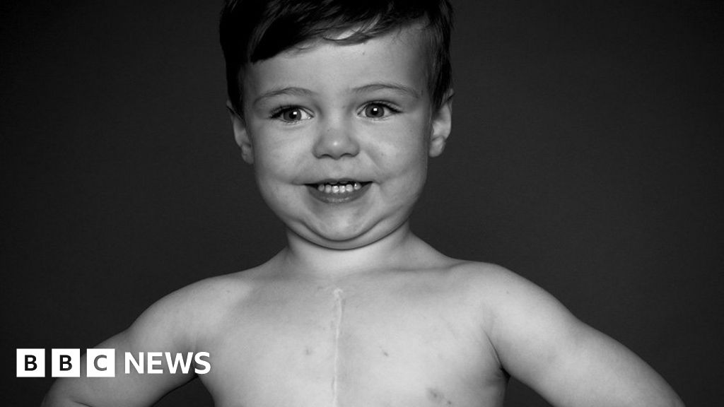 'You should be proud of your scar' - BBC News