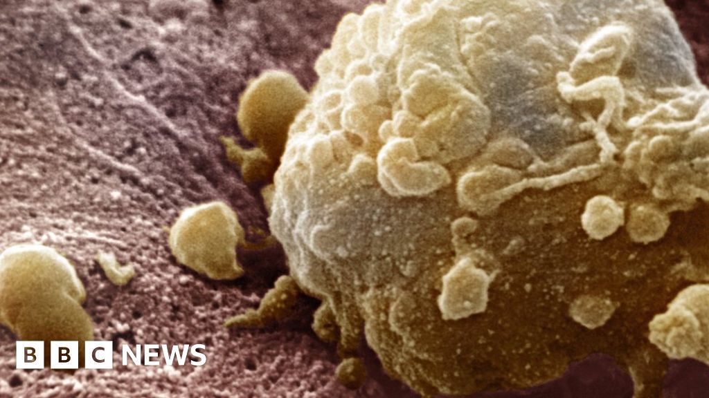 Melanoma blood test: Scientists unveil 'world-first' research - BBC News