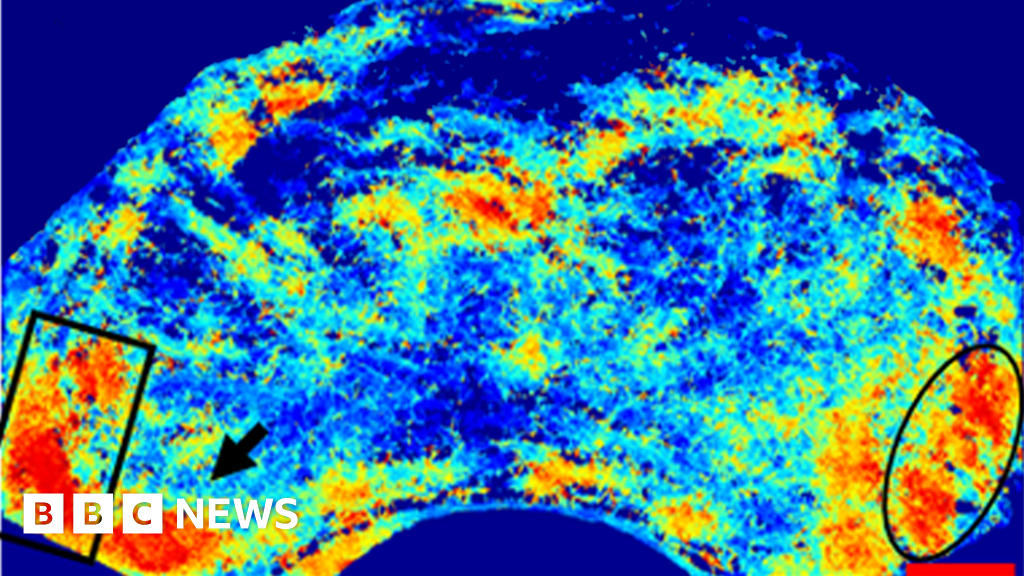 Ultrasound breakthrough 'can spot cancer earlier' - BBC News