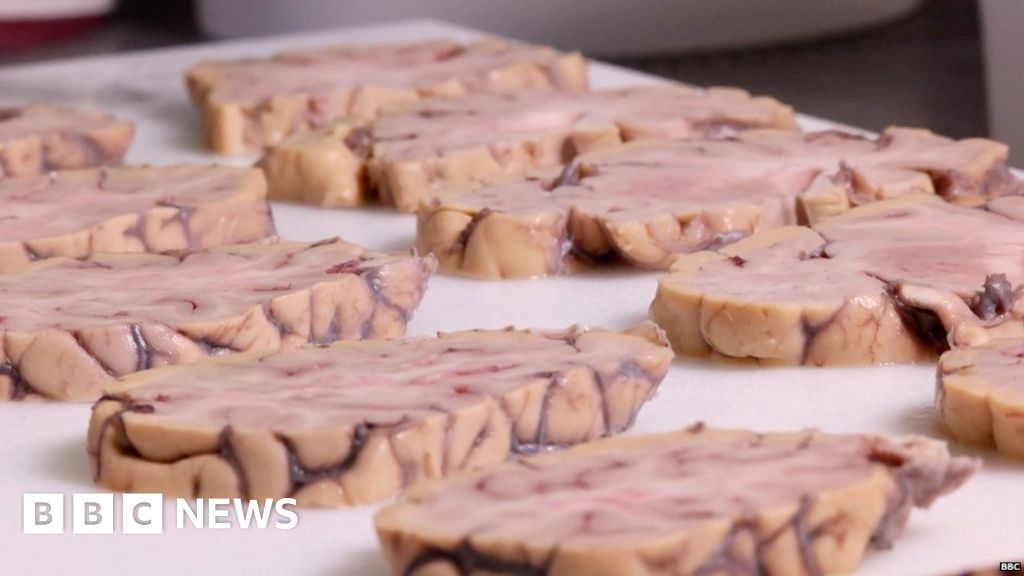 Dissecting brains for medical research - BBC News