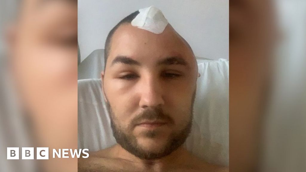 Man has part of skull removed after Mansfield attack - BBC News