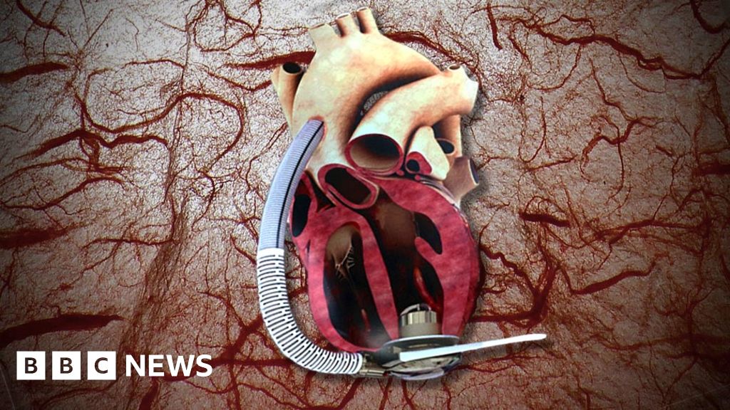 UK's first heart pump targets 2018 clinical trial - BBC News