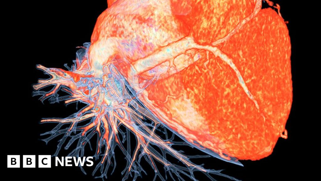 Hundreds more surviving heart failure in hospital, study shows - BBC News