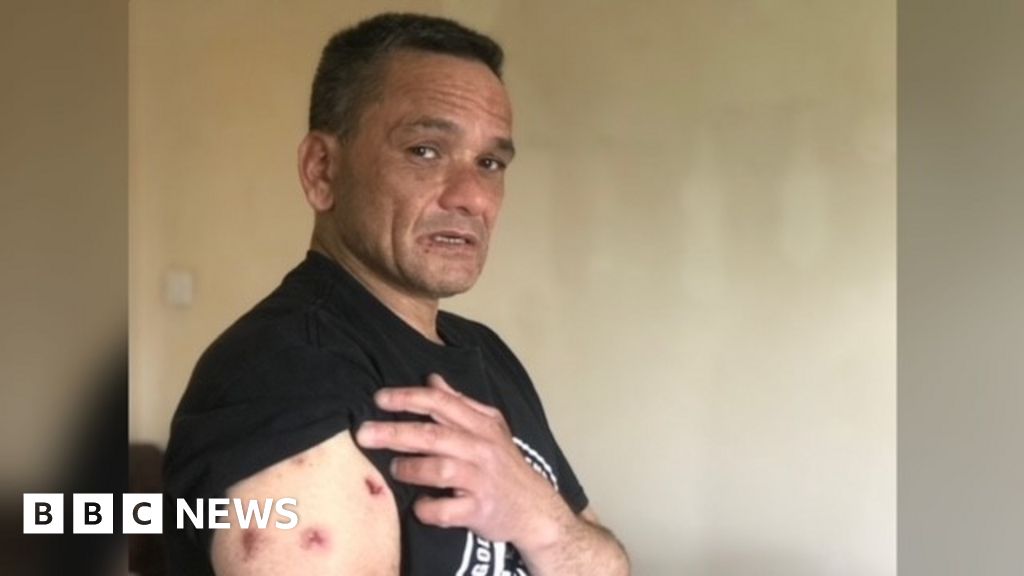 Man bitten hundreds of times due to false widow infestation