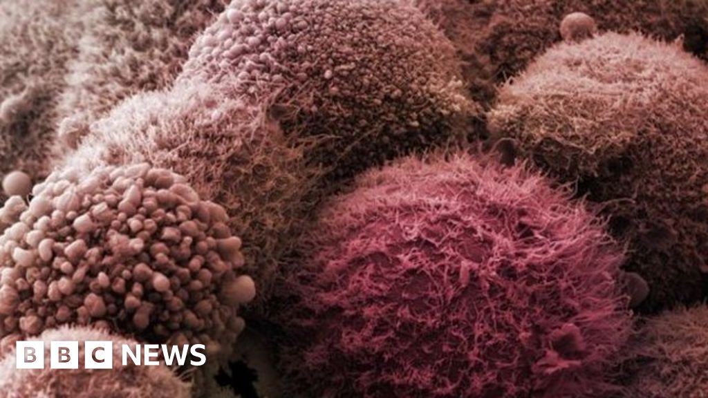 Pancreatic cancer urine test hope - BBC News