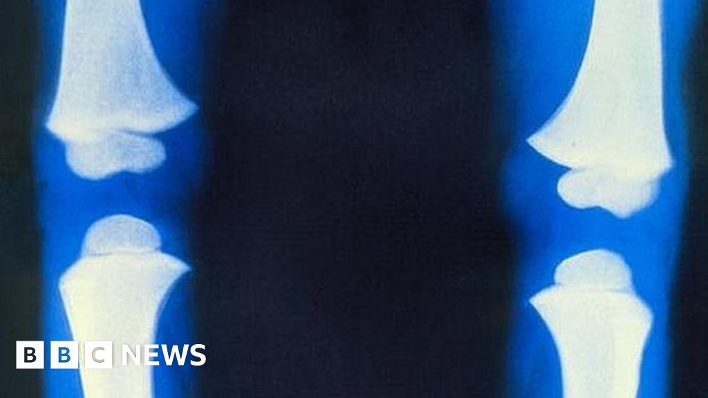 Cumbria baby boy's injuries caused by rickets not violence - BBC News