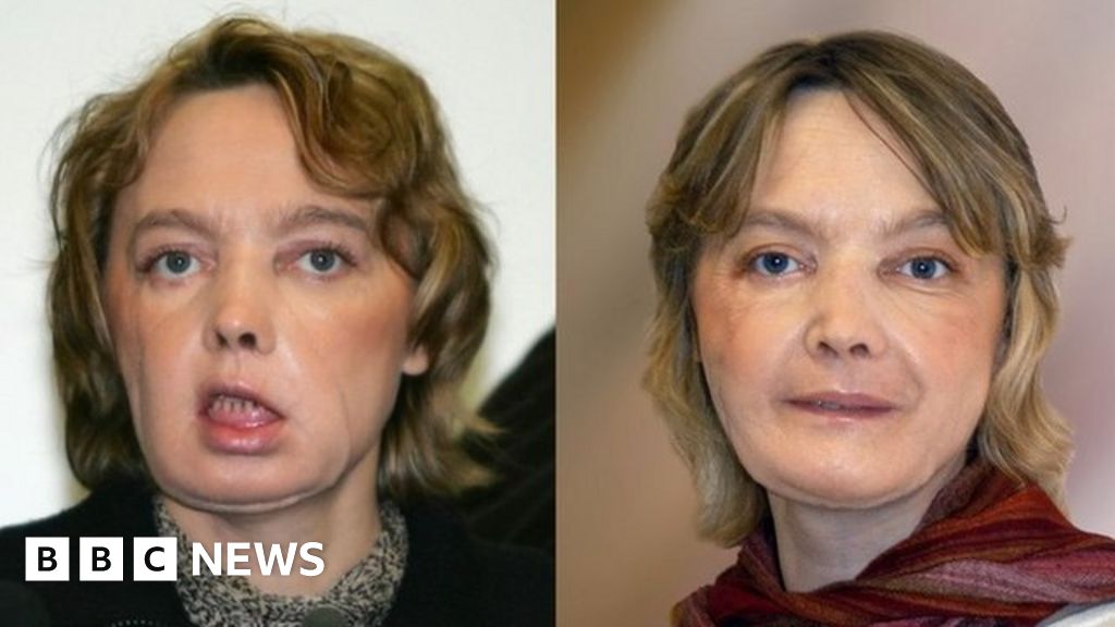 Face transplant patient: 'I couldn't believe what I saw' - BBC News