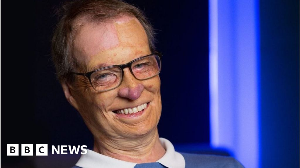 Leo Gormley: Burns survivor smiles with brother's help - BBC News