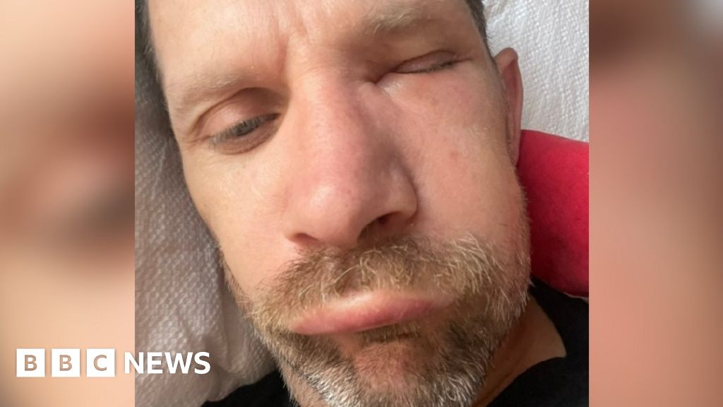 Chesterfield councillor thanks NHS for help with swollen face - BBC News