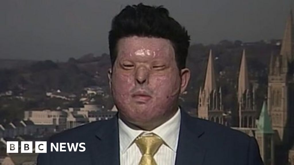 Acid victim: 'I will have my injuries to the grave'