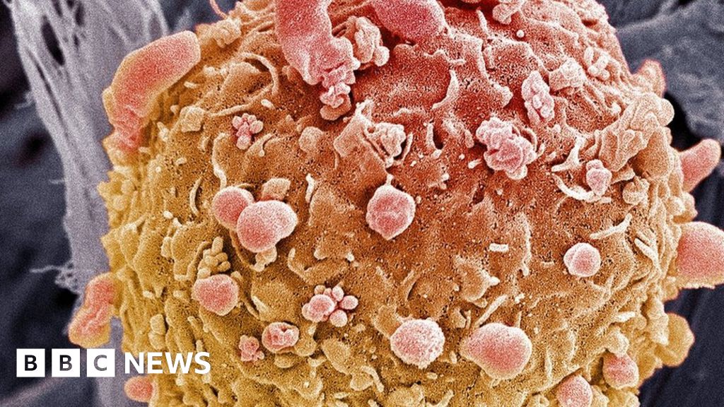 Skin cancer prevention trial at Churchill Hospital under way - BBC News