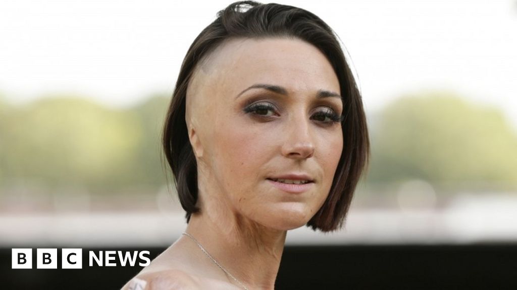 Acid attack victim Adele Bellis plans school talks - BBC News