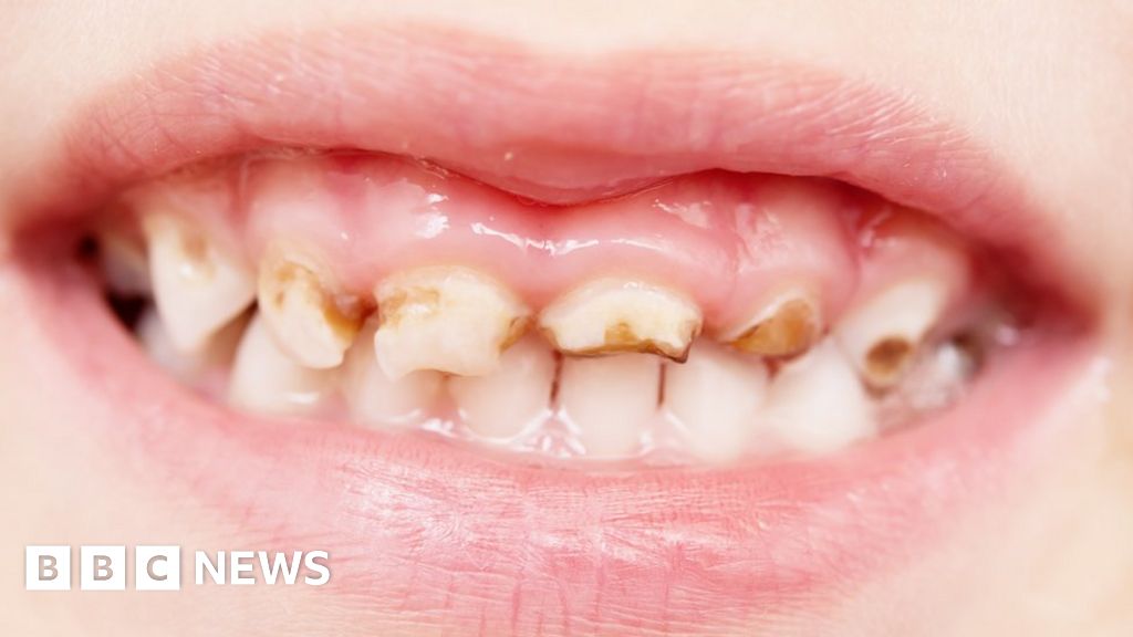 Under fives tooth decay 'improving' - BBC News