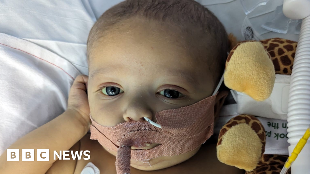 Family of Burslem baby hoping to take him for surgery in Belgium