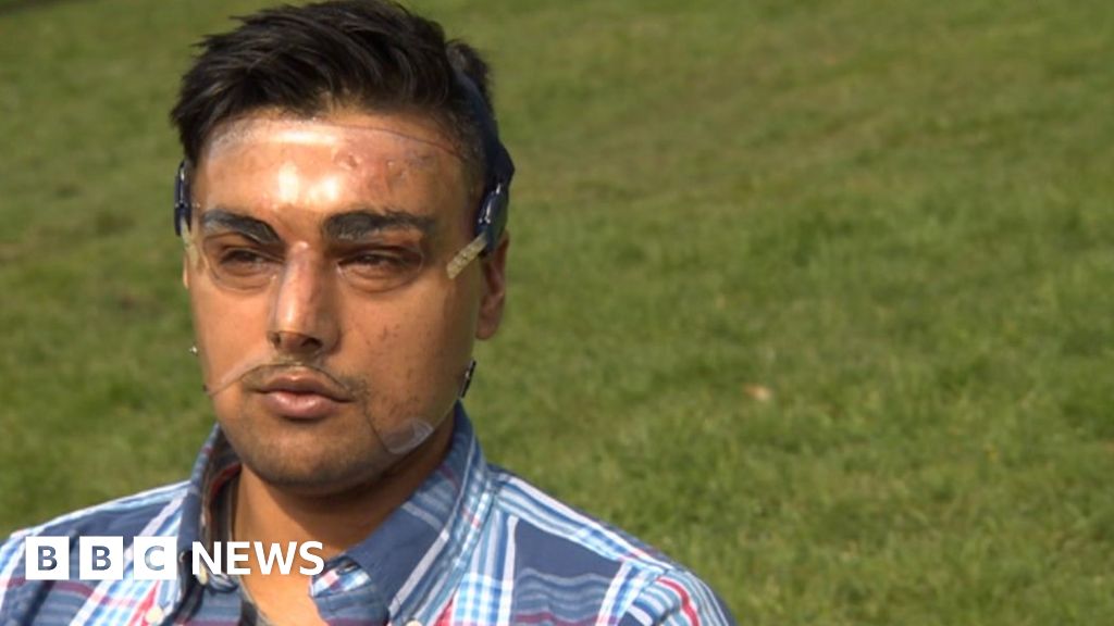 Acid victim describes 'cold shock' of attack - BBC News