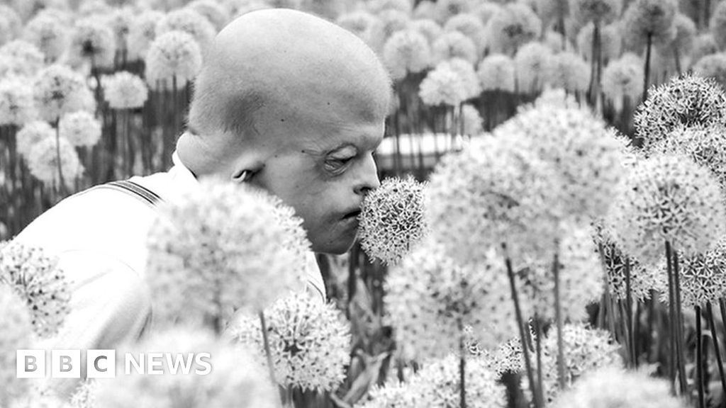 Teenager with rare disability flourishes in new home