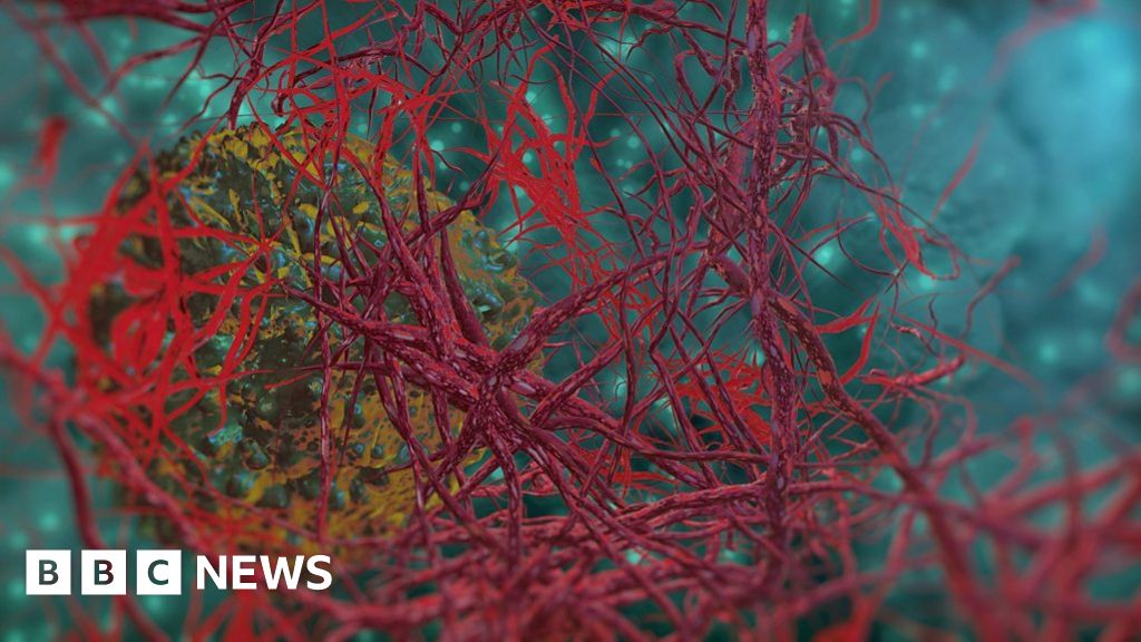 Study reveals avoidable causes of cancer - BBC News