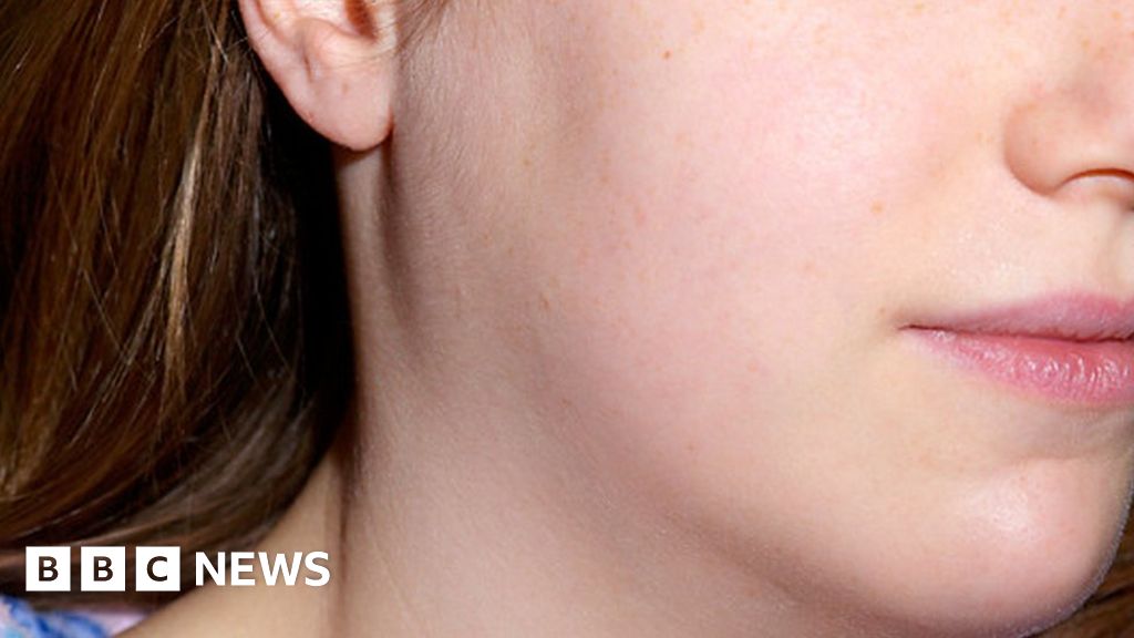 Mumps Northern Ireland Cases 700 Rise Down To Vaccine Cycle